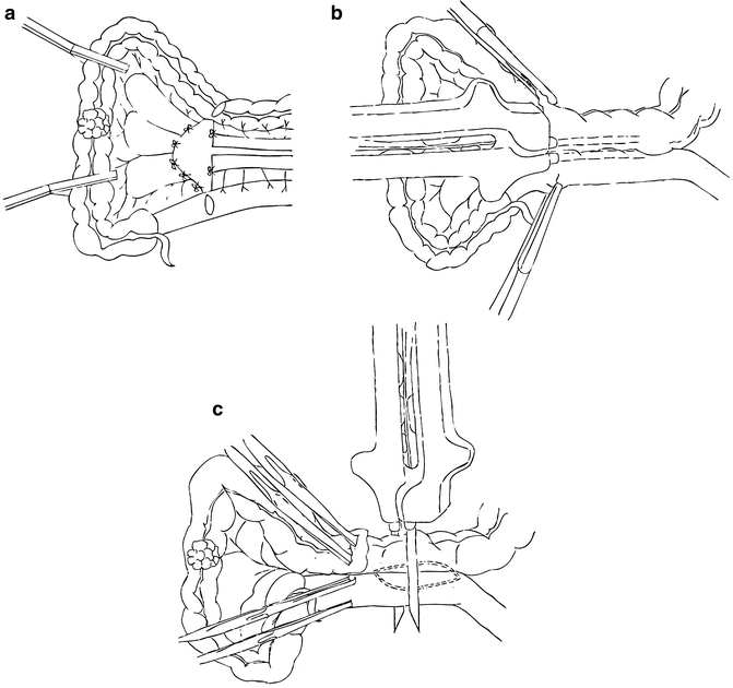 Open Right Colectomy Abdominal Key