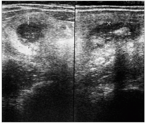 C15-FF8.gif | Abdominal Key