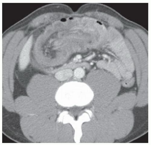 C2-FF186.gif | Abdominal Key