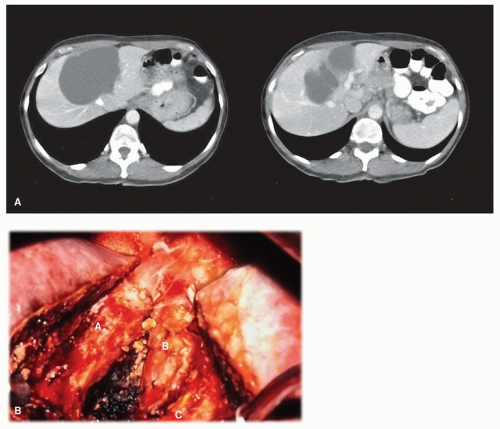 C25-FF4.gif | Abdominal Key