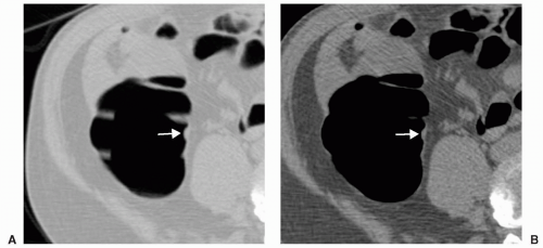 C5-FF10.gif | Abdominal Key