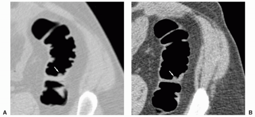 C5-FF15.gif | Abdominal Key
