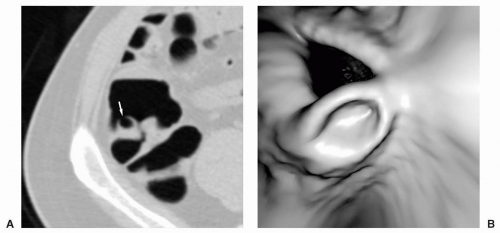 C6-FF62.gif | Abdominal Key