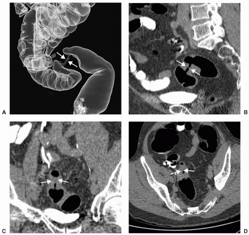 C7-FF2.gif | Abdominal Key
