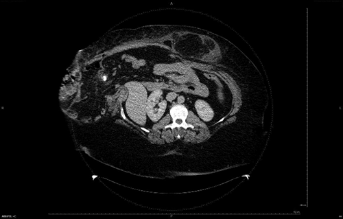 DA3C27FF7.gif | Abdominal Key