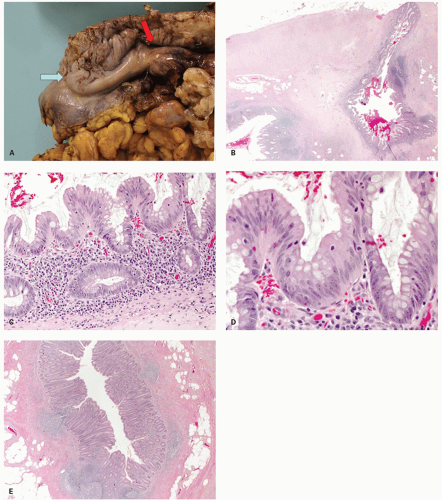 C15-FF52.gif | Abdominal Key