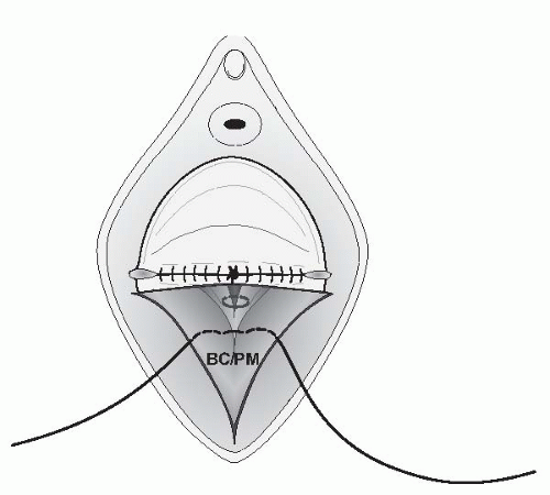 C31-FF13.gif | Abdominal Key