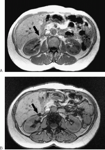 C3-2-FF66.gif | Abdominal Key