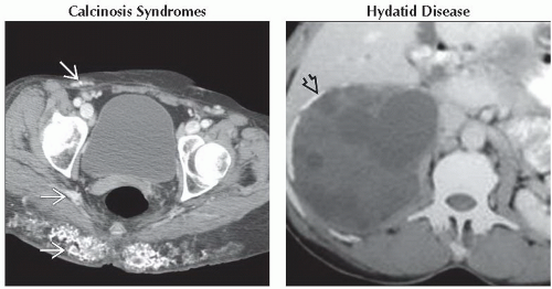 DA1-DB1-Abdominal_Calcifications-FFU11.gif | Abdominal Key