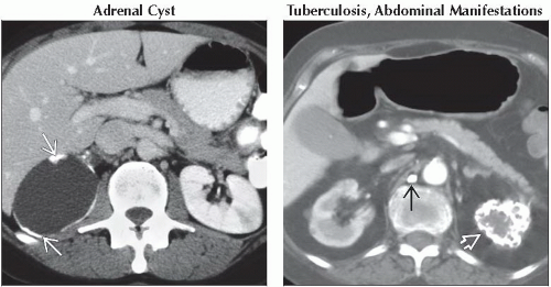 DA1-DB1-Abdominal_Calcifications-FFU13.gif | Abdominal Key