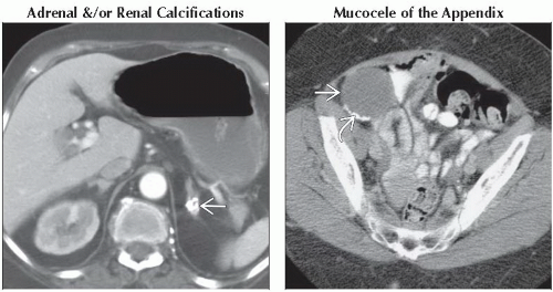 DA1-DB1-Abdominal_Calcifications-FFU14.gif | Abdominal Key