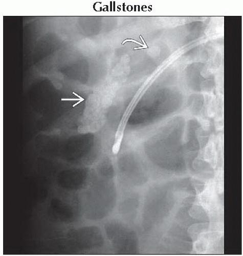 DA1-DB1-Abdominal_Calcifications-FFU2.gif | Abdominal Key