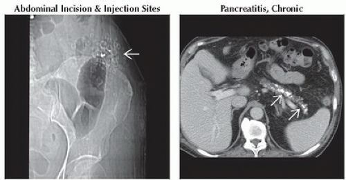 DA1-DB1-Abdominal_Calcifications-FFU5.gif | Abdominal Key