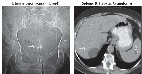 DA1-DB1-Abdominal_Calcifications-FFU7.gif | Abdominal Key