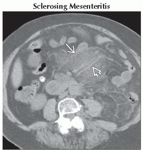 DA1-DB1-Fat_Containing_Lesion_Peritoneal_Cavity-FFU1.gif | Abdominal Key