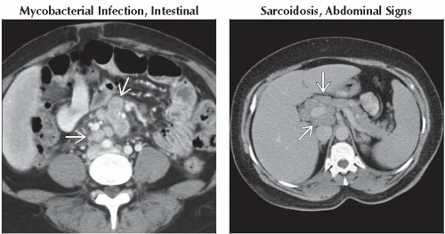 DA1-DB1-Mesenteric_Lymphadenopathy-FFU7.gif | Abdominal Key