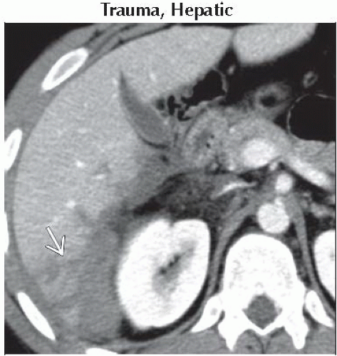 DA1-DB2-High_Attenuation_Hyperdense_Ascites-FFU2.gif | Abdominal Key