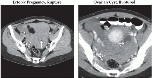 DA1-DB2-High_Attenuation_Hyperdense_Ascites-FFU4.gif | Abdominal Key