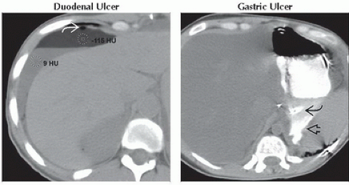 DA1-DB2-High_Attenuation_Hyperdense_Ascites-FFU7.gif | Abdominal Key