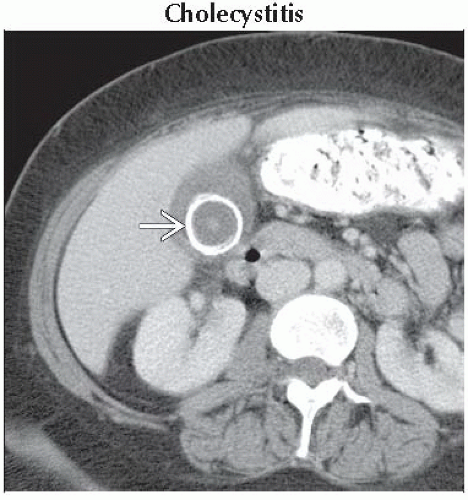 DA10-DB1-Diffuse_Gallbladder_Wall_Thickening-FFU1.gif | Abdominal Key