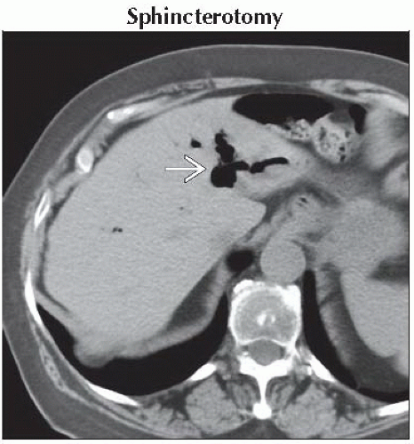 DA10-DB1-Gas_in_Bile_Ducts_or_Gallbladder-FFU1.gif | Abdominal Key