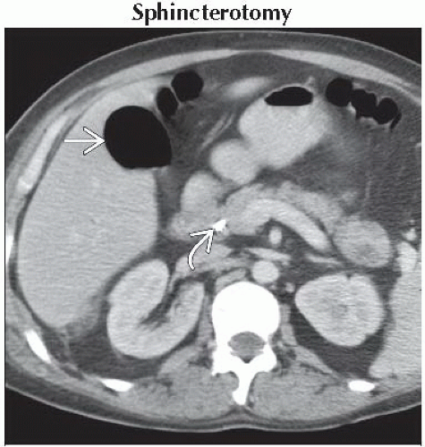 DA10-DB1-Gas_in_Bile_Ducts_or_Gallbladder-FFU2.gif | Abdominal Key