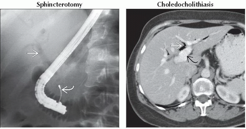 DA10-DB1-Gas_in_Bile_Ducts_or_Gallbladder-FFU3.gif | Abdominal Key