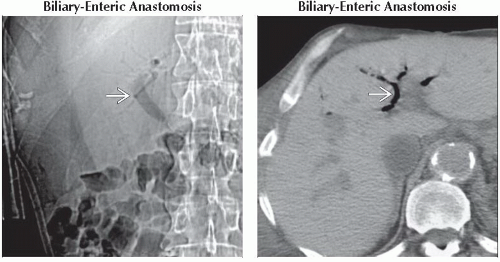 DA10-DB1-Gas_in_Bile_Ducts_or_Gallbladder-FFU4.gif | Abdominal Key