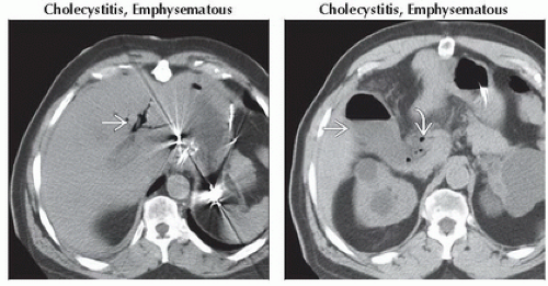 DA10-DB1-Gas_in_Bile_Ducts_or_Gallbladder-FFU6.gif | Abdominal Key