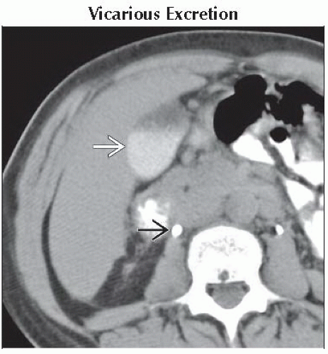DA10-DB2-High_Attenuation_Hyperdense_Bile_in_Gallbladder-FFU1.gif ...