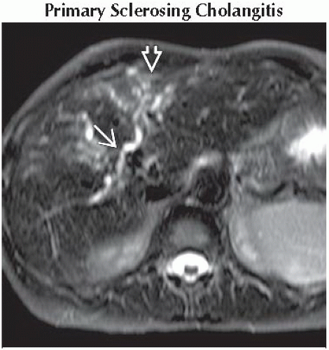 DA11-DB1-Asymmetric_Dilation_of_Intrahepatic_Bile_Ducts-FFU1.gif ...