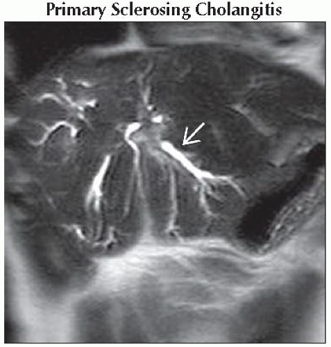 DA11-DB1-Asymmetric_Dilation_of_Intrahepatic_Bile_Ducts-FFU2.gif ...