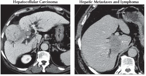DA11-DB1-Asymmetric_Dilation_of_Intrahepatic_Bile_Ducts-FFU4.gif ...