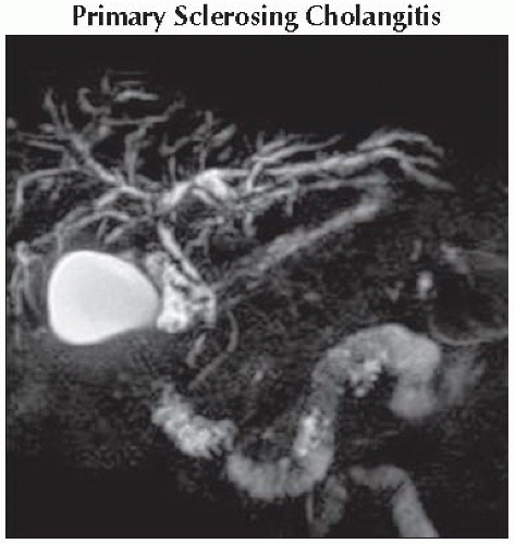 DA11-DB1-Biliary_Strictures_Multiple-FFU1.gif | Abdominal Key