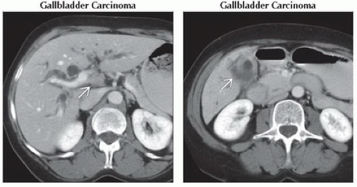 DA11-DB1-Dilated_Common_Bile_Duct-FFU10.gif | Abdominal Key