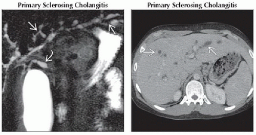 DA11-DB1-Dilated_Common_Bile_Duct-FFU11.gif | Abdominal Key