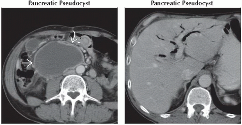 DA11-DB1-Dilated_Common_Bile_Duct-FFU12.gif | Abdominal Key