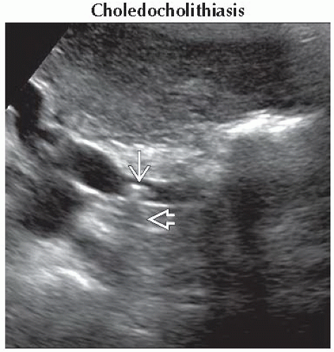 DA11-DB1-Dilated_Common_Bile_Duct-FFU2.gif | Abdominal Key