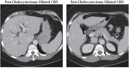 DA11-DB1-Dilated_Common_Bile_Duct-FFU3.gif | Abdominal Key