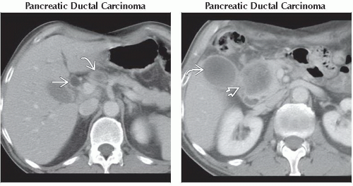 DA11-DB1-Dilated_Common_Bile_Duct-FFU4.gif | Abdominal Key