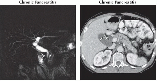 DA11-DB1-Dilated_Common_Bile_Duct-FFU5.gif | Abdominal Key