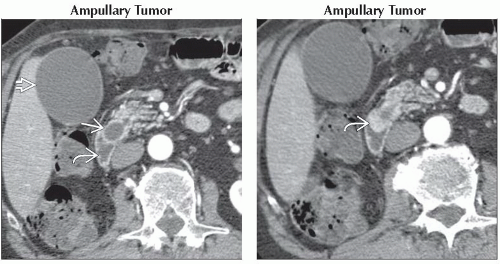 DA11-DB1-Dilated_Common_Bile_Duct-FFU6.gif | Abdominal Key