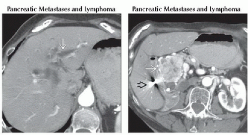 DA11-DB1-Dilated_Common_Bile_Duct-FFU8.gif | Abdominal Key