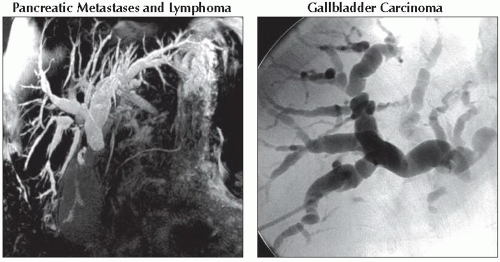DA11-DB1-Dilated_Common_Bile_Duct-FFU9.gif | Abdominal Key
