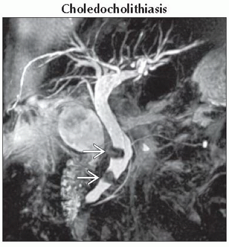 DA11-DB2-Hypointense_Lesion_in_Biliary_Tree_MRCP-FFU1.gif | Abdominal Key
