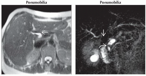 DA11-DB2-Hypointense_Lesion_in_Biliary_Tree_MRCP-FFU3.gif | Abdominal Key