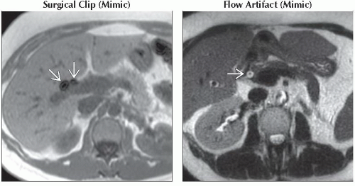 DA11-DB2-Hypointense_Lesion_in_Biliary_Tree_MRCP-FFU4.gif | Abdominal Key