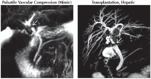 DA11-DB2-Hypointense_Lesion_in_Biliary_Tree_MRCP-FFU5.gif | Abdominal Key