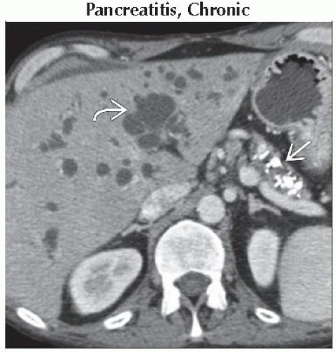 DA12-DB1-Atrophy_or_Fatty_Replacement_of_Pancreas-FFU1.gif | Abdominal Key
