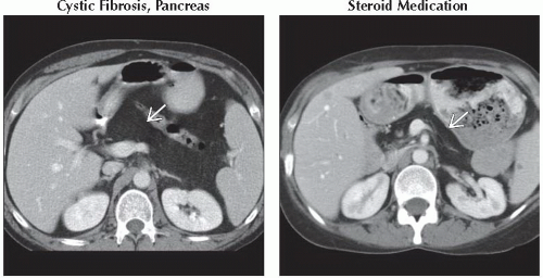 DA12-DB1-Atrophy_or_Fatty_Replacement_of_Pancreas-FFU3.gif | Abdominal Key